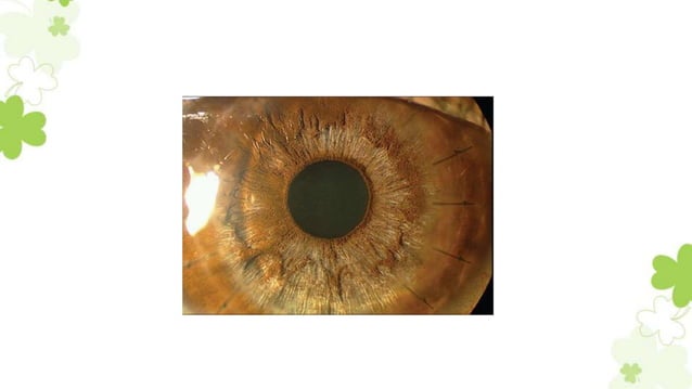 Postoperative Complication of DALK | PPTX | Eye and Vision Conditions ...