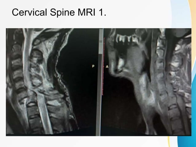 Clowards Anterior approach with Interbody fusion in a patient with AO ...