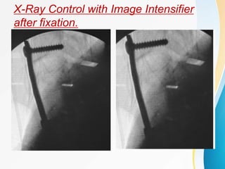 Clowards Anterior approach with Interbody fusion in a patient with AO ...