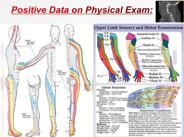 Clowards Anterior approach with Interbody fusion in a patient with AO ...