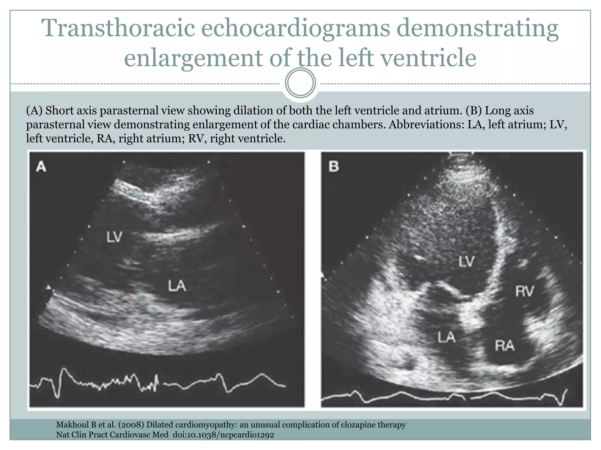 Clozapine and its cardiac adverse effects | PPTX
