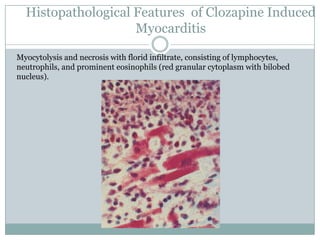 Clozapine and its cardiac adverse effects | PPTX