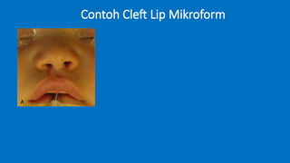 Cleft Lip and Palate atau Sumbing pada bibir dan langitan | PPTX