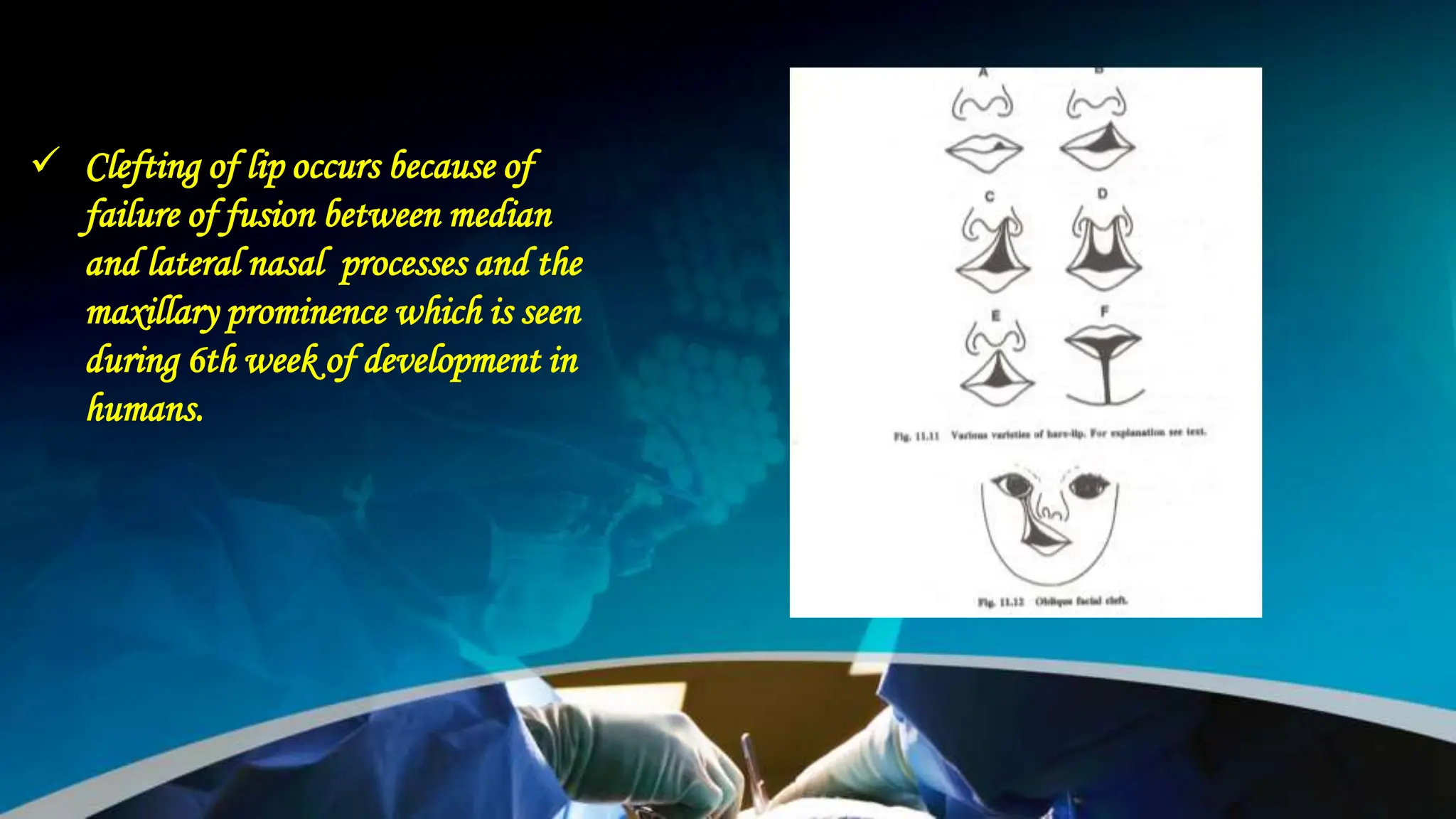 CLEFT LIP AND PALATE IN ORTHODONTICS.pptx