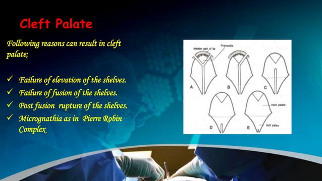 CLEFT LIP AND PALATE IN ORTHODONTICS.pptx