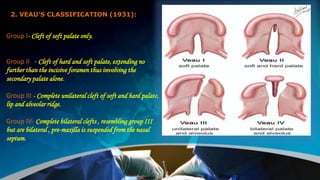 CLEFT LIP AND PALATE IN ORTHODONTICS.pptx