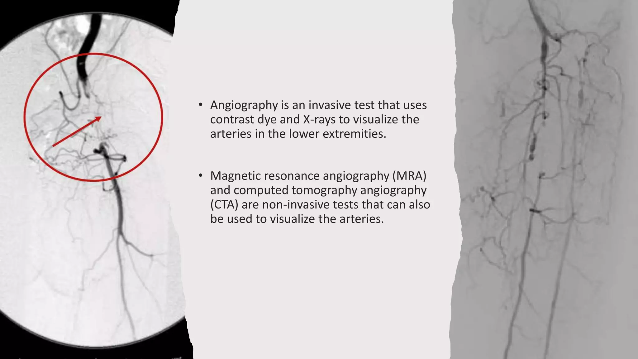 Chronic Threatening Limb Ischemia CTLI | PPSX