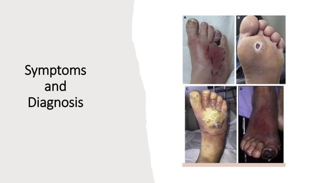 Chronic Threatening Limb Ischemia CTLI | PPSX | Heart and ...