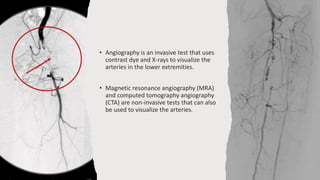 Chronic Threatening Limb Ischemia CTLI | PPSX