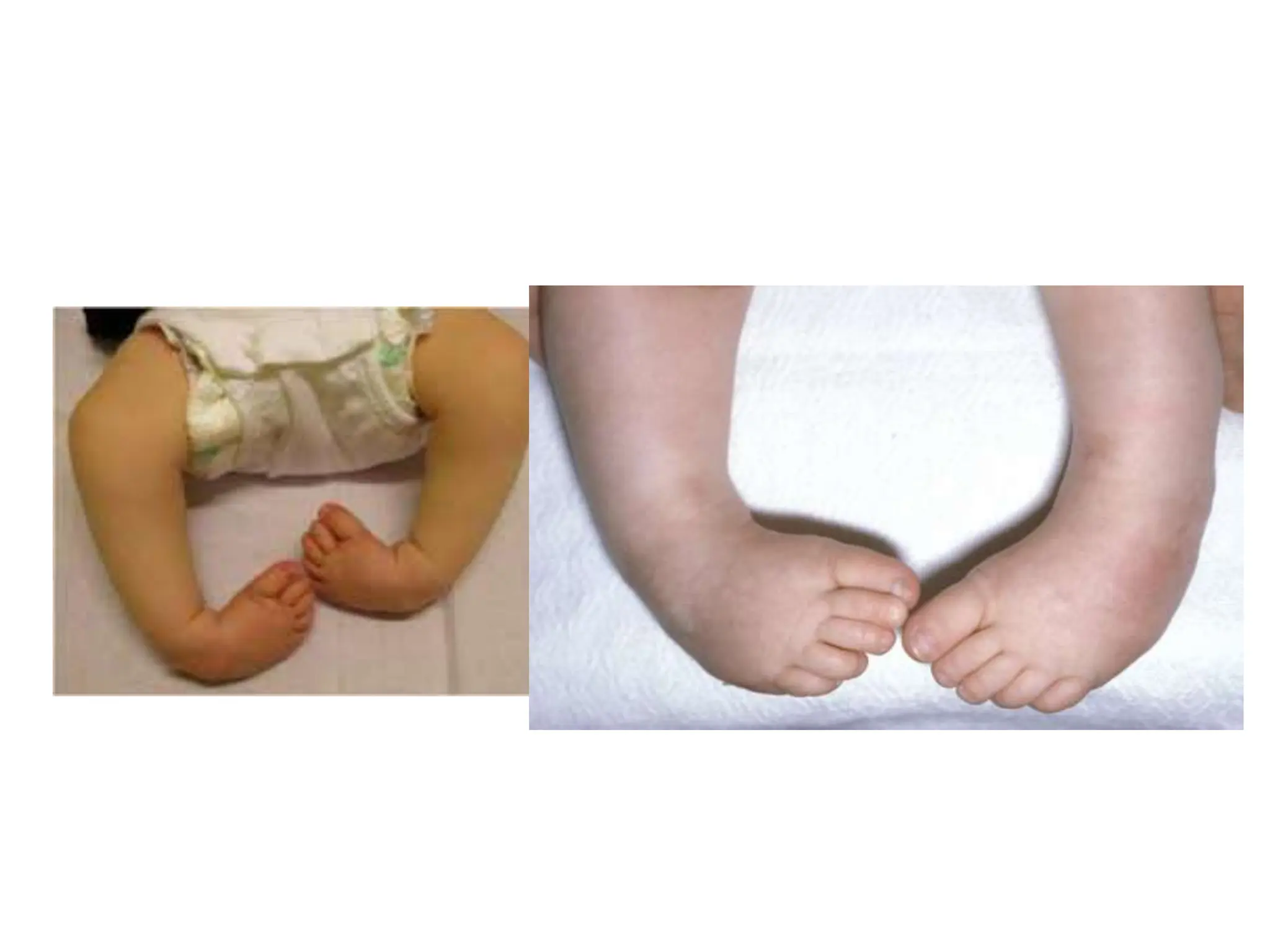 club-foot in children pediatric nursing.pptx