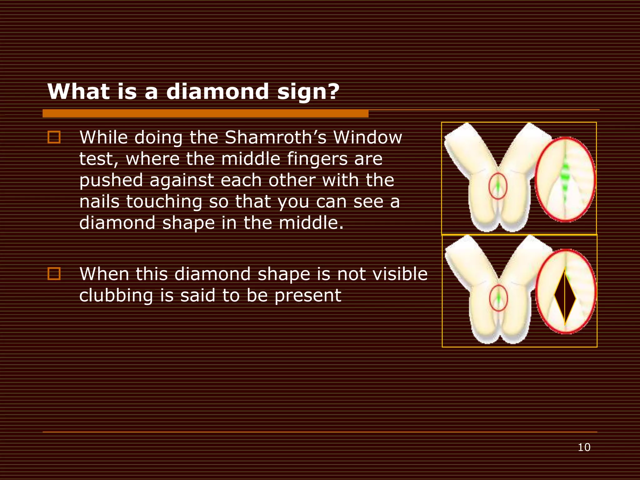 Clubbing | PPTX | Nail Care | Beauty