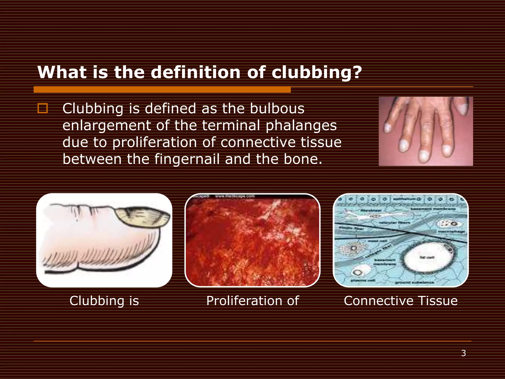 Clubbing | PPTX