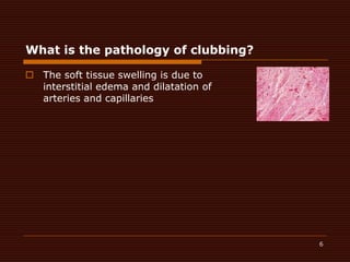 Clubbing | PPTX