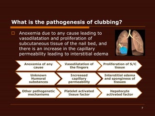 Clubbing | PPTX