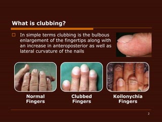 Clubbing | PPT