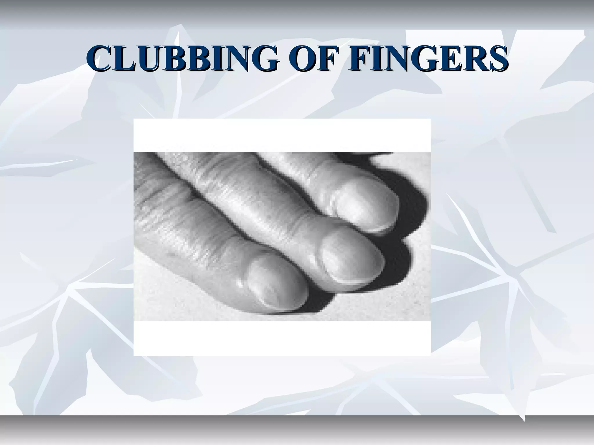 Clubbing | PPT