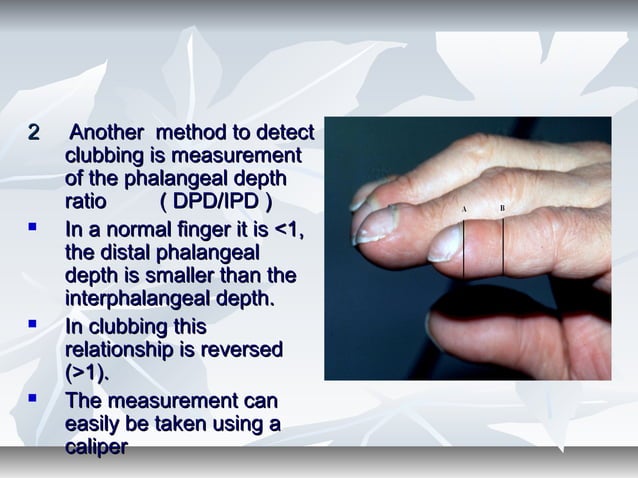 Clubbing | PPT | Lung and Respiratory Health | Diseases and Conditions