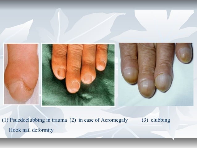 Clubbing | PPT | Lung and Respiratory Health | Diseases and Conditions