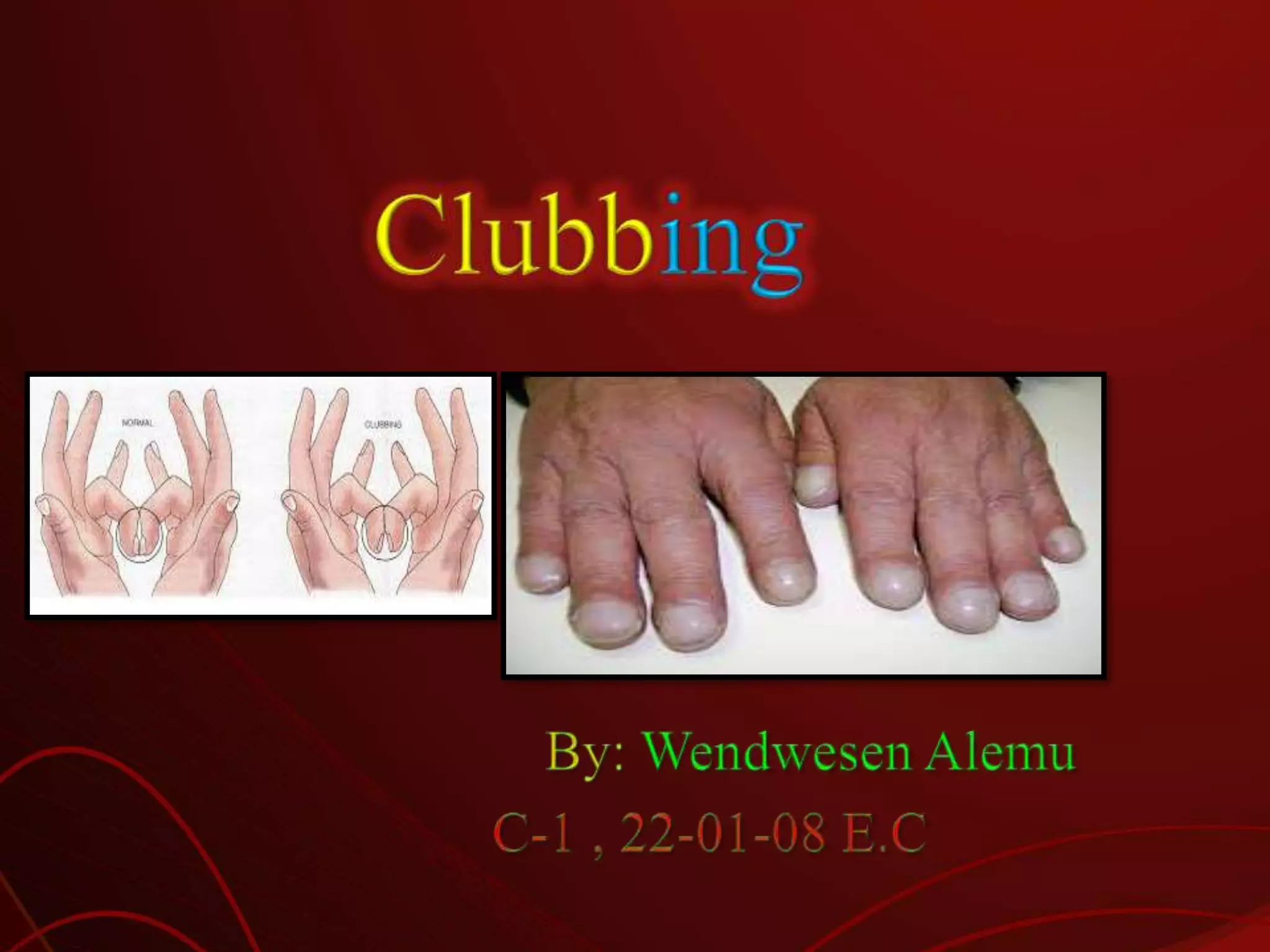Clubbing | PPTX