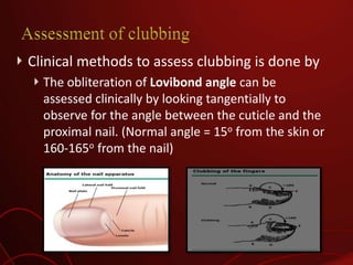 Clubbing | PPT | Free download