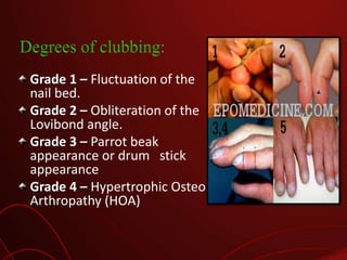 Clubbing | PPT | Free download