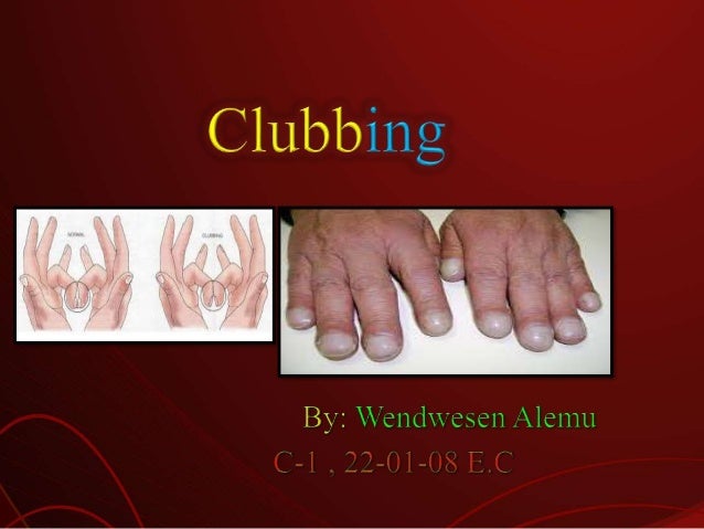 Clubbing
