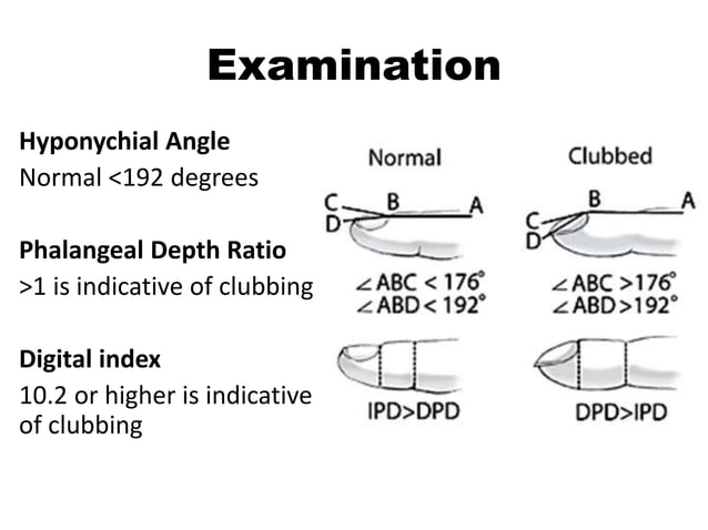Clubbing | PPTX | Lung and Respiratory Health | Diseases and Conditions