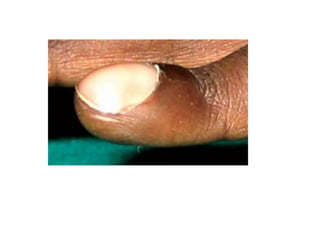 General physical examination CLUBBING.pptx