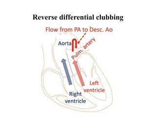 Approach to Clubbing (differential diagnosis, grading, mechanism ...