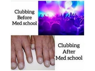 Approach to Clubbing (differential diagnosis, grading, mechanism ...
