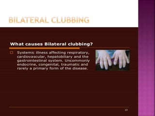 Clubbing agp | PPT