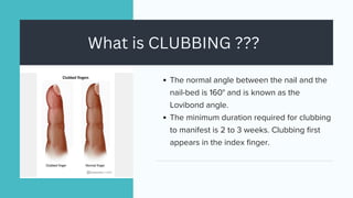 Clubbing (General Medicine) by SSH.pdf