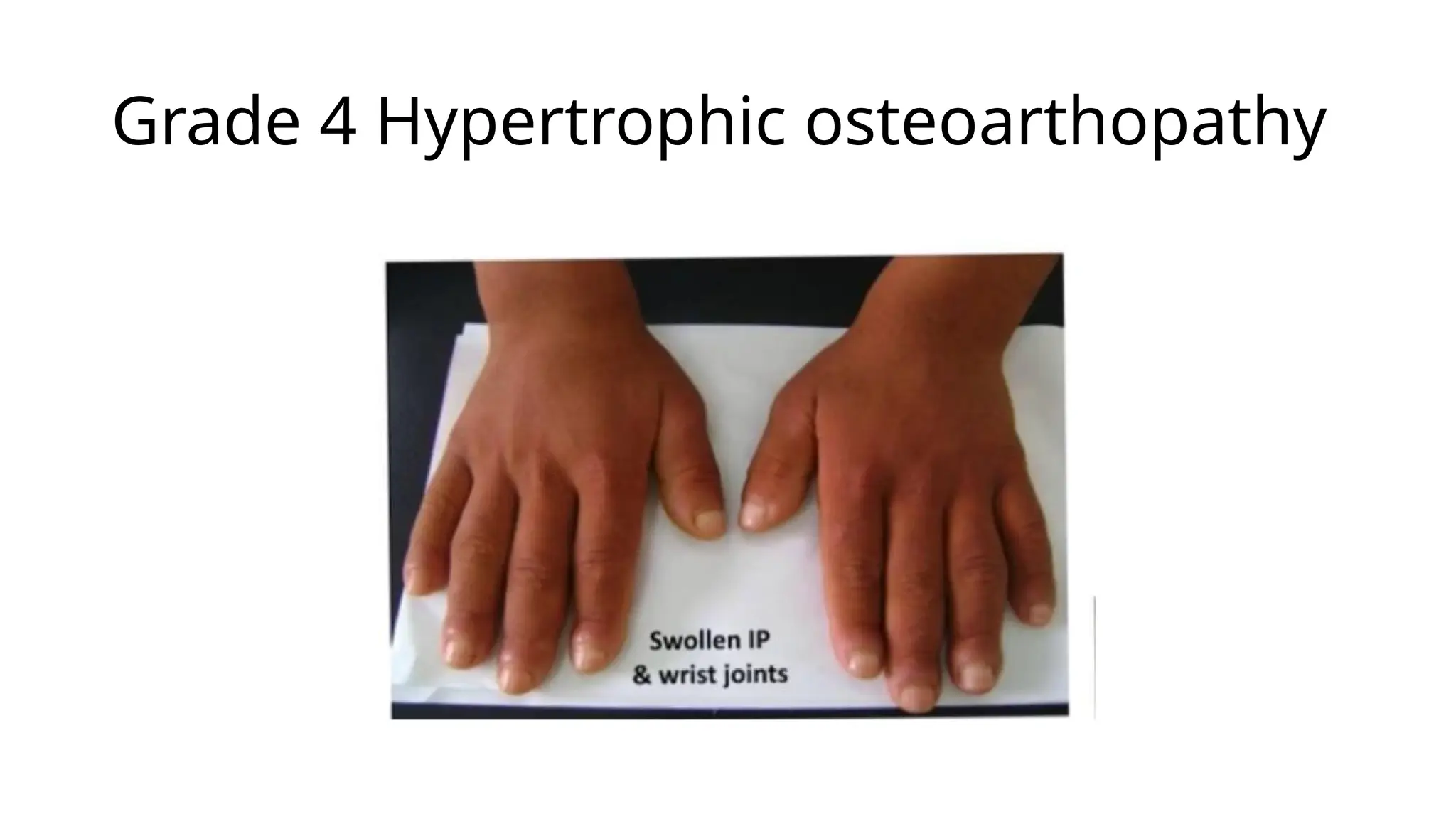 clubbing ppt.pptx. definition, clinical signs, grades. Causes | PPTX