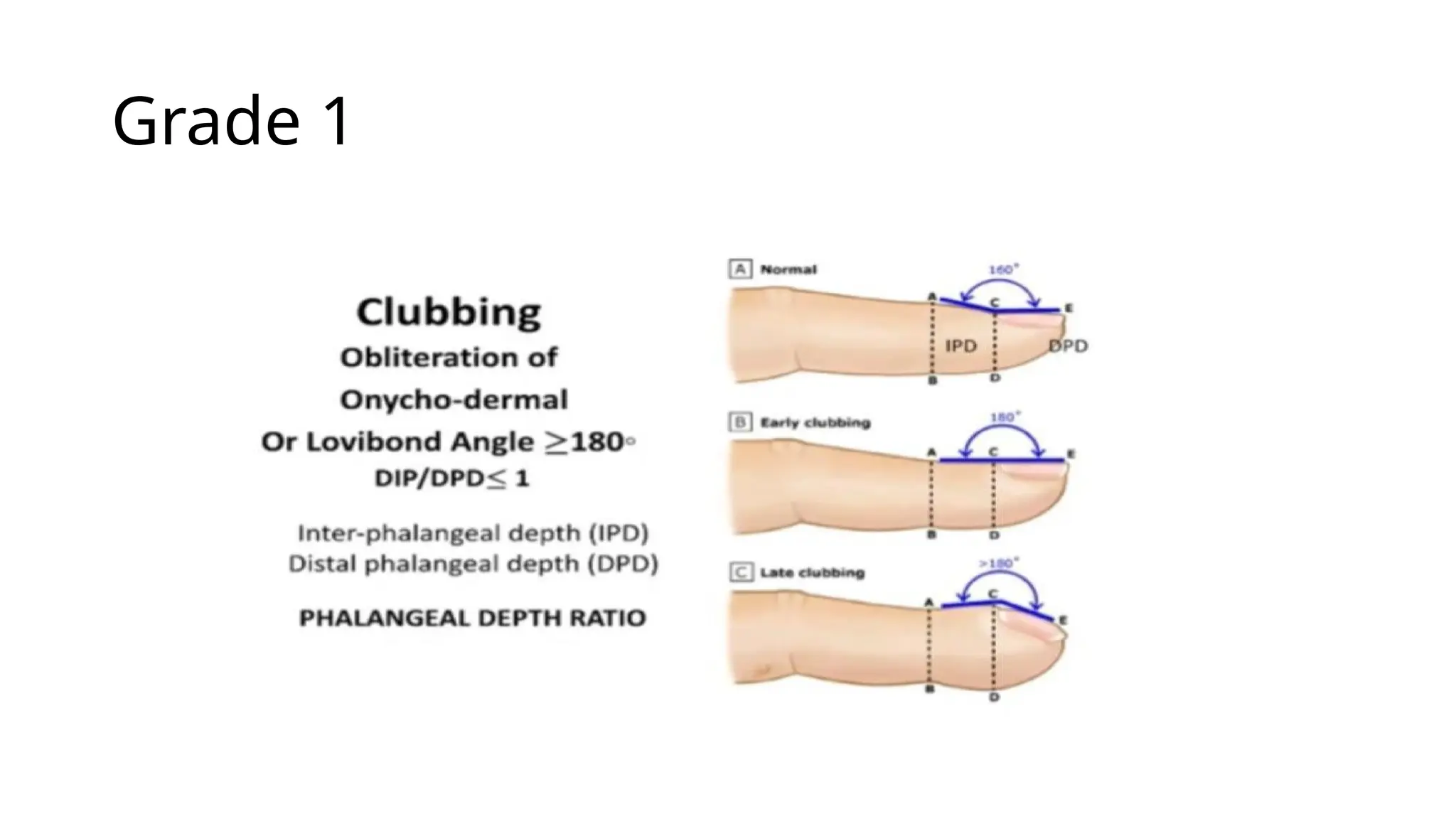 clubbing ppt.pptx. definition, clinical signs, grades. Causes | PPTX