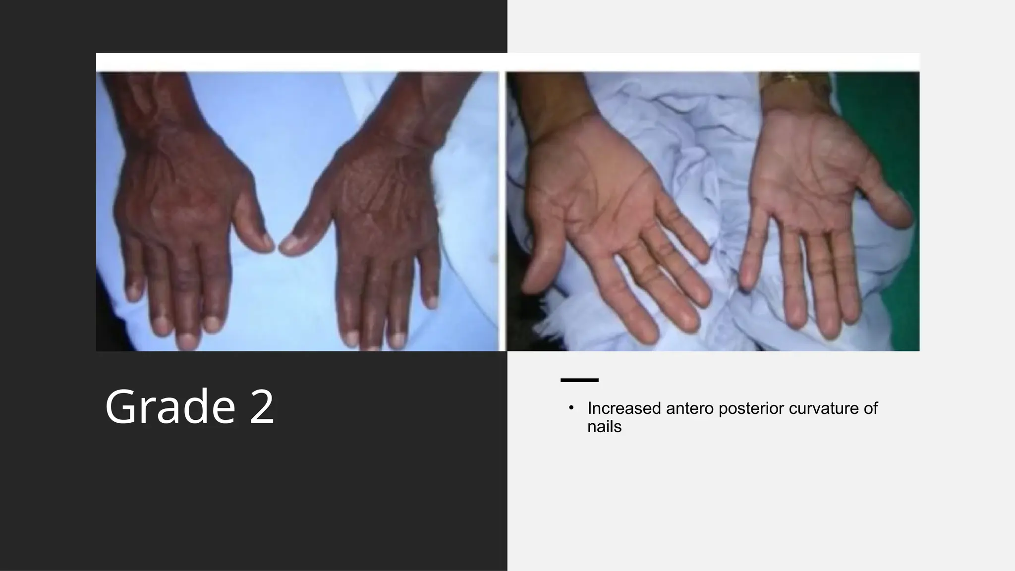 clubbing ppt.pptx. definition, clinical signs, grades. Causes | PPTX