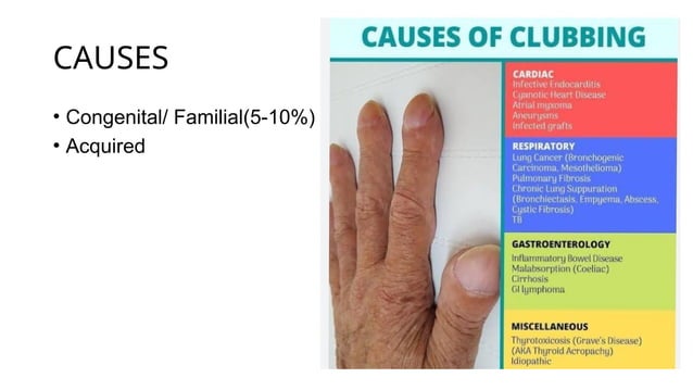 clubbing ppt.pptx. definition, clinical signs, grades. Causes | PPTX
