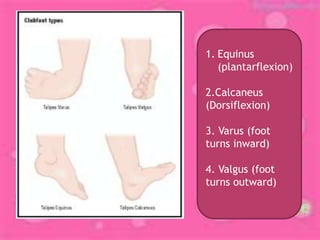 Clubfoot | PPTX