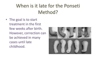 Clubfoot:The Ponseti Method | PPTX