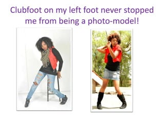 Clubfoot:The Ponseti Method | PPTX