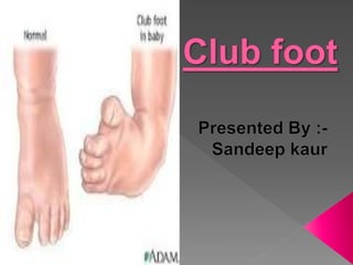 Club foot | PDF