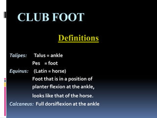 Club foot | PPTX