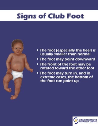 Club Foot | PDF