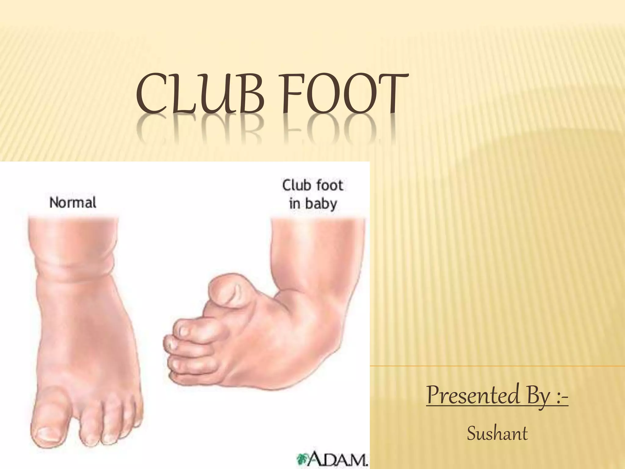 Club foot | PPTX