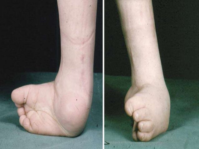 Club foot | PPTX