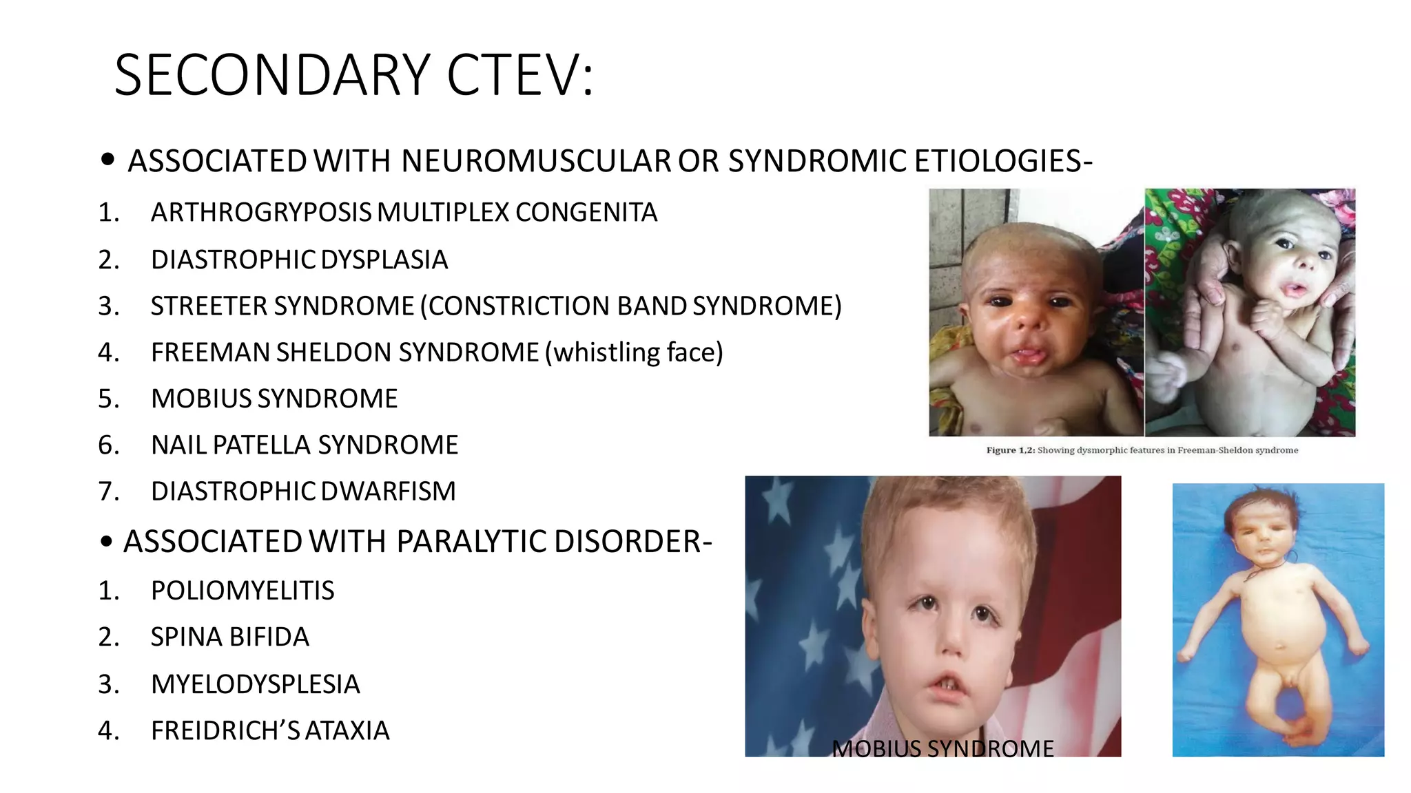 Club foot / CTEV | PDF