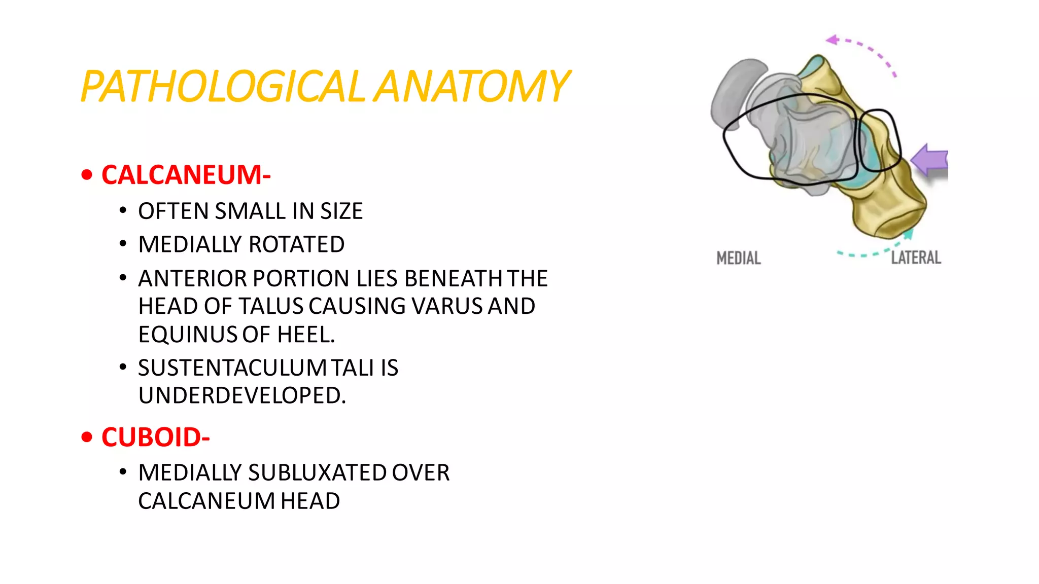 Club foot / CTEV | PDF