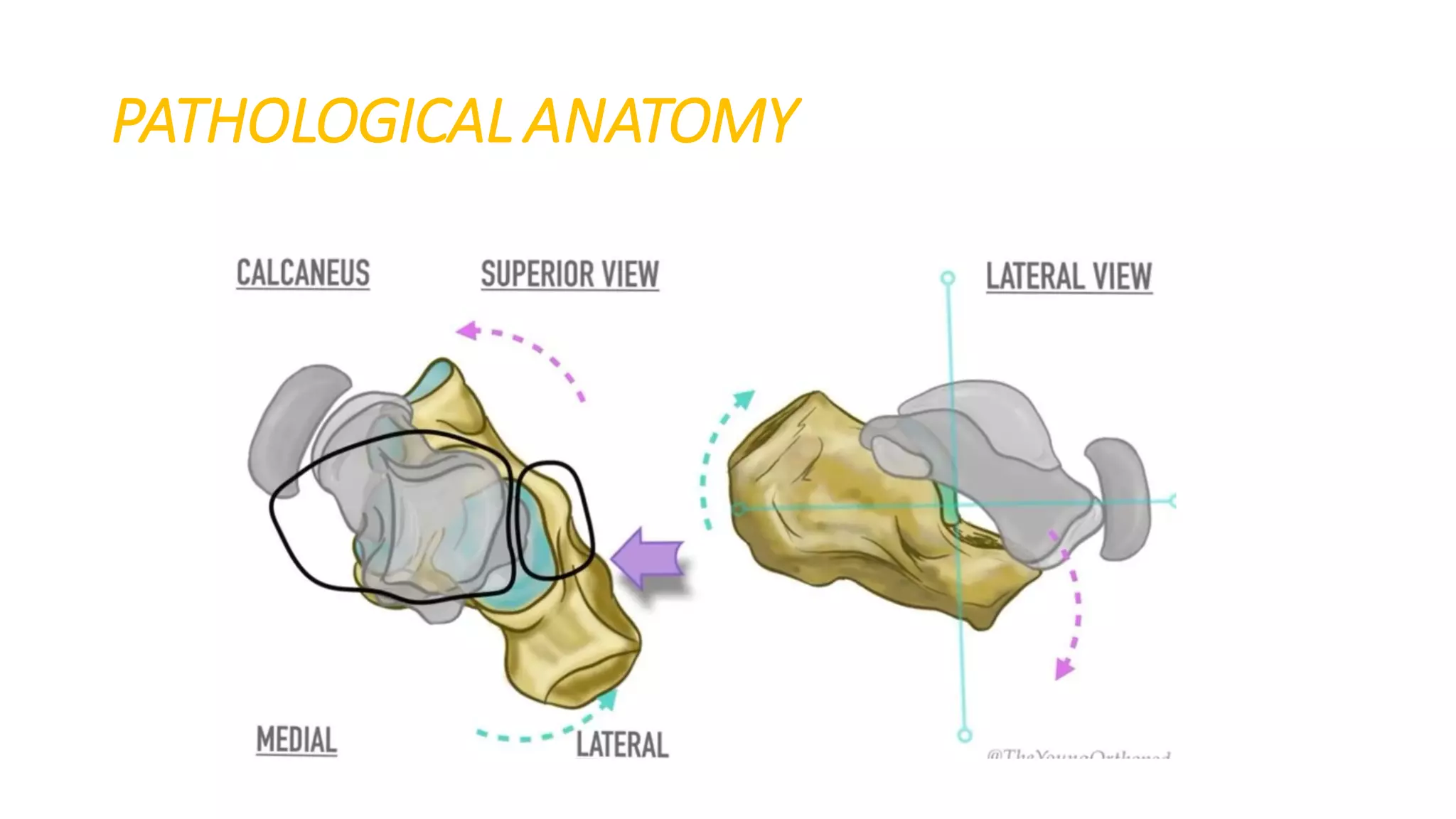 Club foot / CTEV | PDF