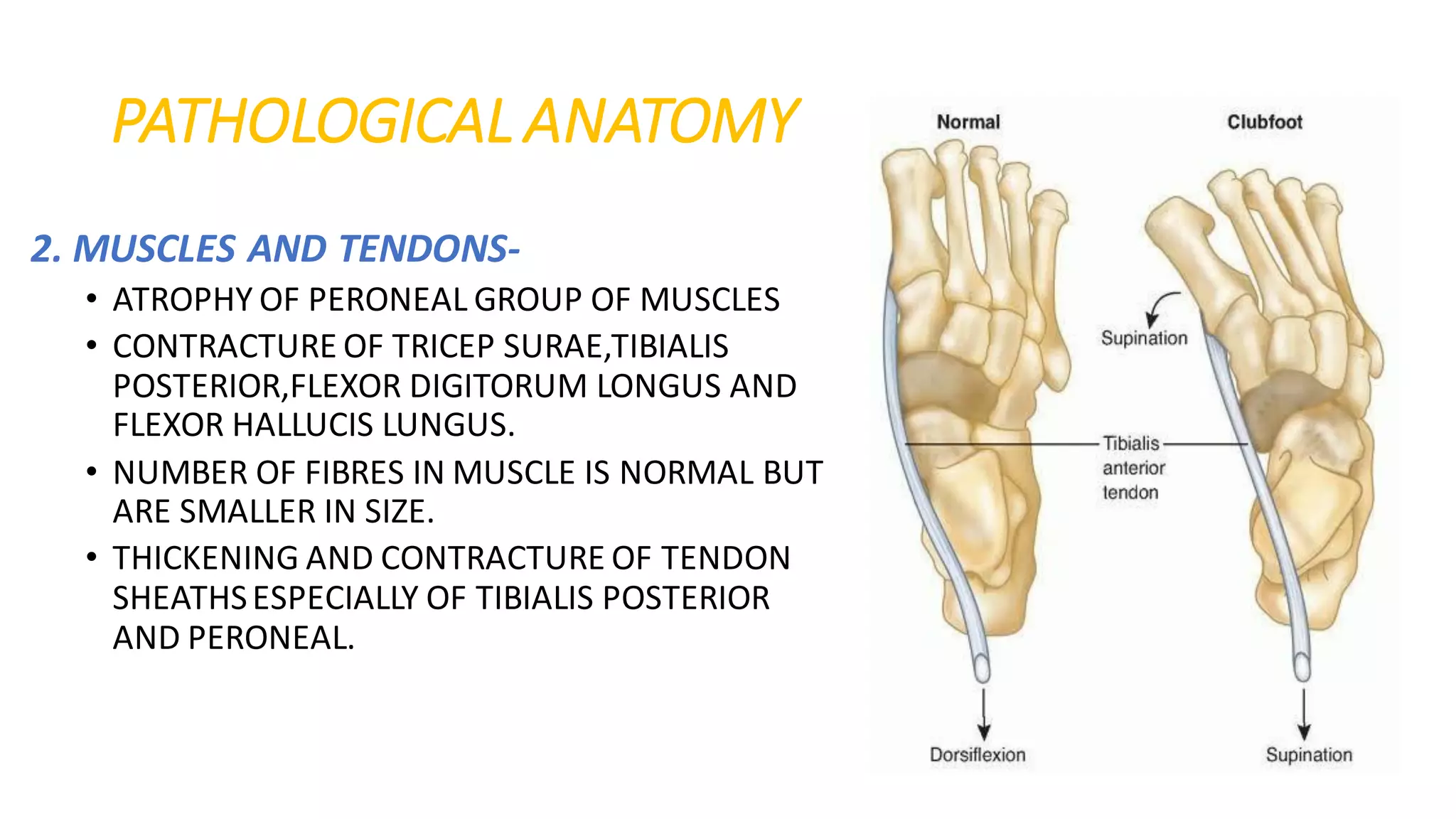 Club foot / CTEV | PDF
