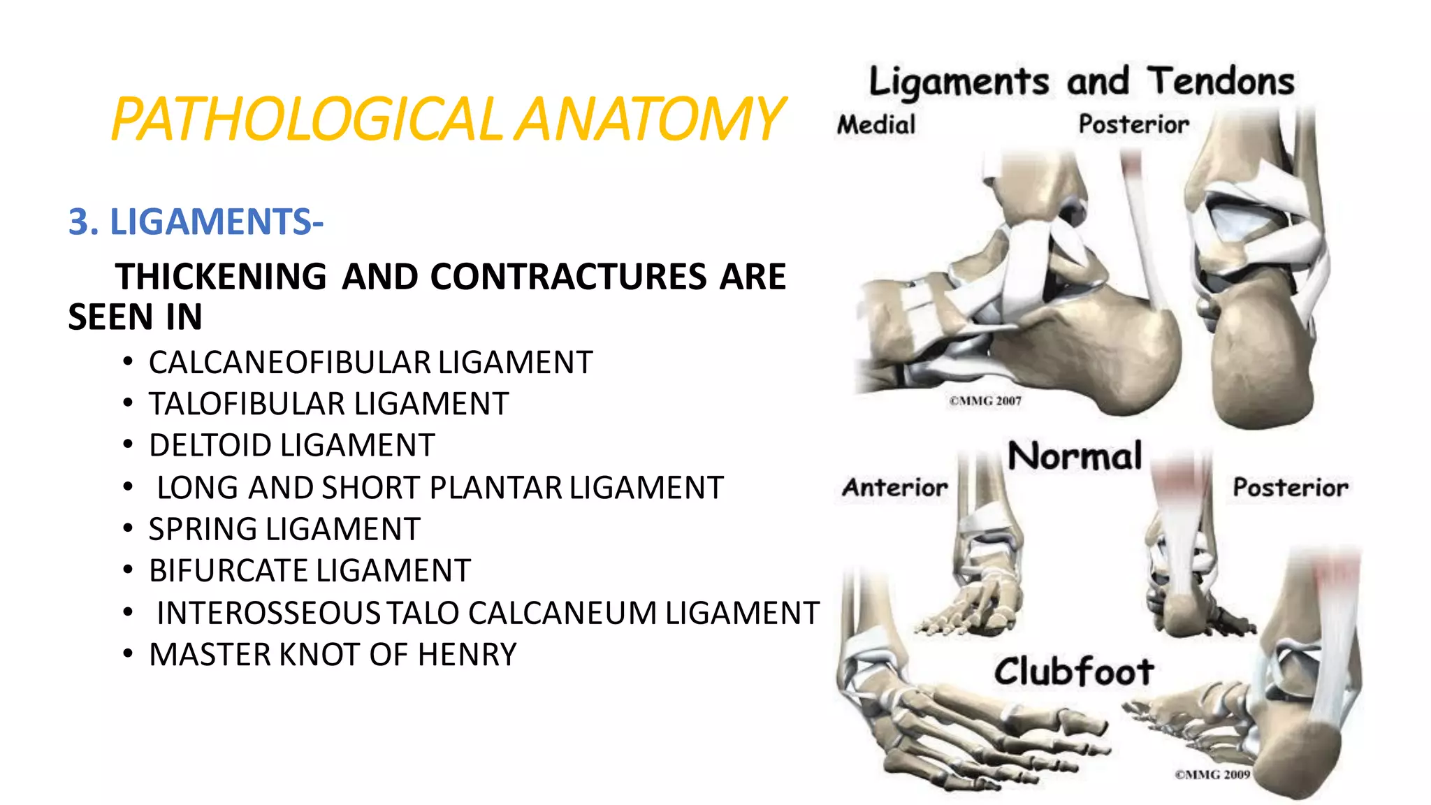 Club foot / CTEV | PDF
