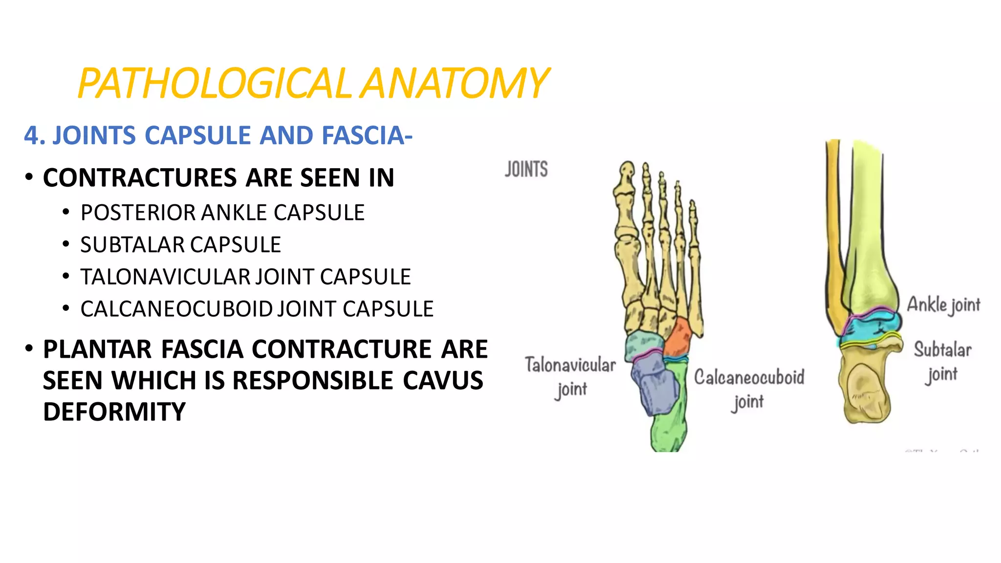 Club foot / CTEV | PDF